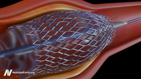 Heart Stents and Their Risks | Empowered 4 Health